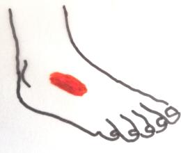 Vaten: Diabetesvoet | Fysiotransparant