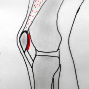 Gewricht: klacht achter knieschijf (of patella femoraal pijn syndroom ...