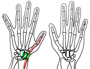 Quervain Aaos Tenosynovitis Tendinitis Tendinosis Symptoms Extensor ...