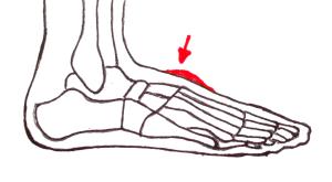 Bot of kraakbeen of weke delen of vloeistof: Tarsal boss (verdikking op ...