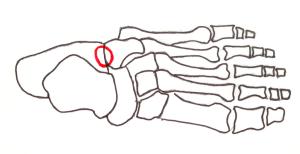 Gewricht: Cuboid syndroom - Fysiotransparant