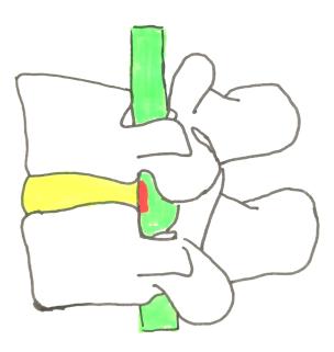 Rug laag: Hernia operatie | Fysiotransparant