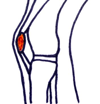 Banden e.a structuren: Verzwikking knieschijf | Fysiotransparant
