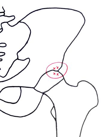 Gewricht e.a structuren: Inklemming thv heup | Fysiotransparant