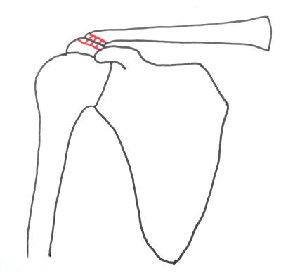 Banden e.a structuren: Verzwikking sleutelbeengewricht thv schouder ...