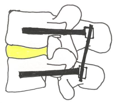 Rug laag: Operatie vastzetten wervels | Fysiotransparant