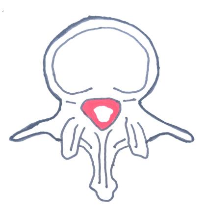 Rug laag: Operatie bij vernauwing wervelkanaal | Fysiotransparant