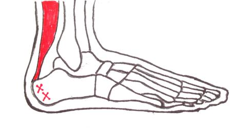 Groeischijf: Hielpijn bij jongeren | Fysiotransparant