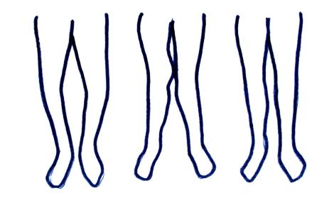 Standvariatie: X- en O benen bij kinderen | Fysiotransparant