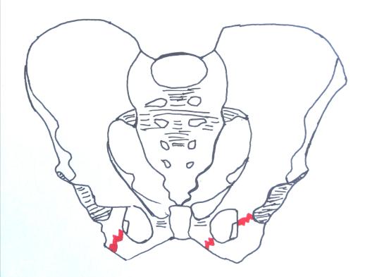 Bot: Bekken botbreuk | Fysiotransparant