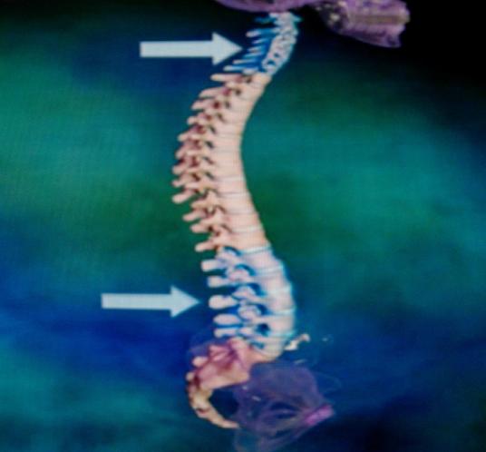 Rug laag: Operatie bij vernauwing wervelkanaal | Fysiotransparant