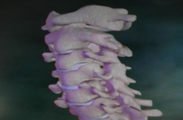 Rug hoog: Hernia operatie | Fysiotransparant