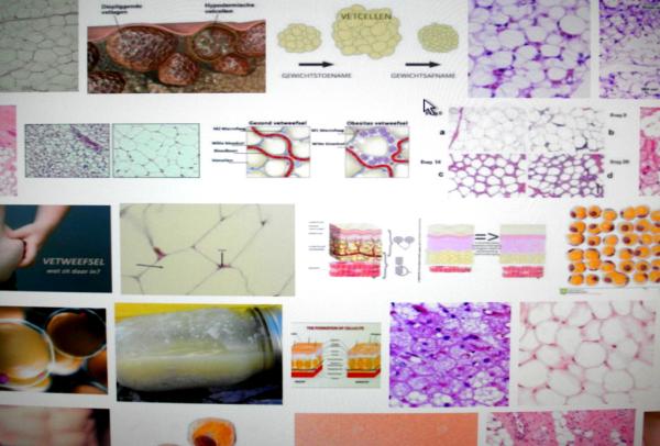 Metabool syndroom | Fysiotransparant