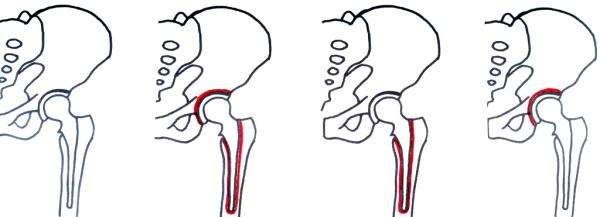 Gewricht: Heupprothese - Fysiotransparant
