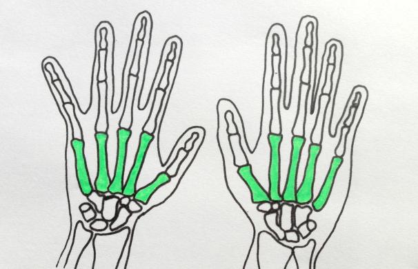 Bot: Botbreuk middenhand | Fysiotransparant