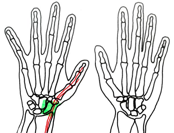 Spier(strek)pees: Klacht strekpees duimzijde pols | Fysiotransparant