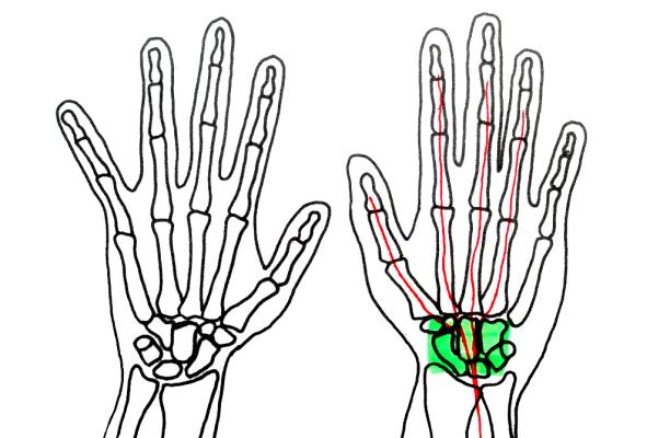 Zenuw n.medianus: Beknelling zenuw handpalmzijde pols | Fysiotransparant