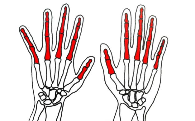 Bot: Botbreuk vinger / duim | Fysiotransparant