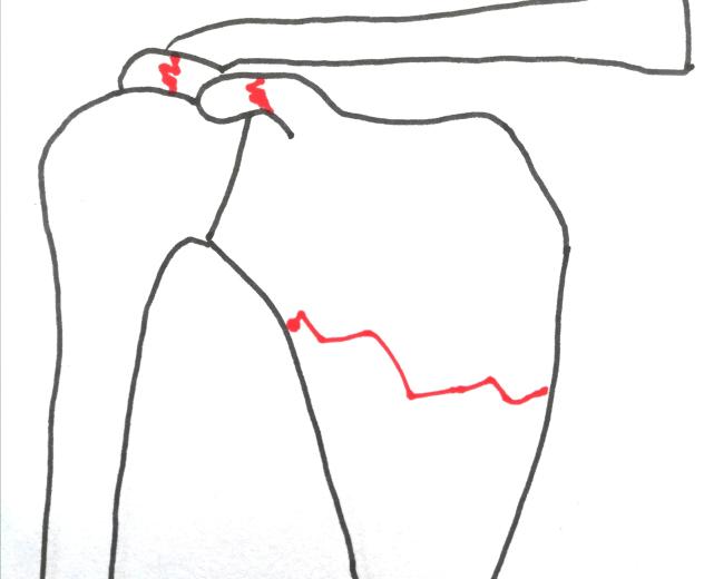 Bot: Schouderblad botbreuk | Fysiotransparant