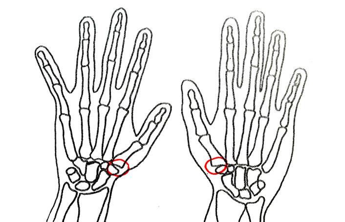 Gewricht: Klacht duimbasis gewricht | Fysiotransparant